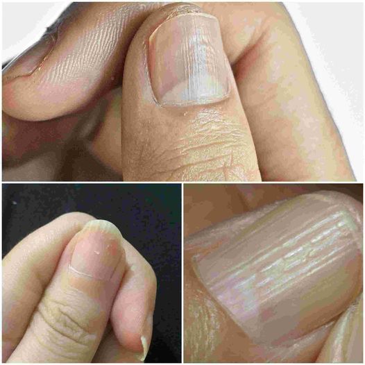 The REAL Causes of Vertical Ridges on Your Nails – Green Tricks