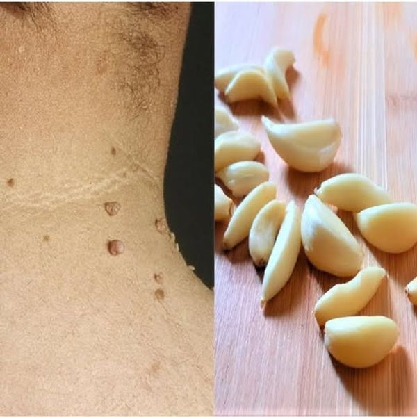 Remove Skin Tags Naturally with Garlic – Fast & Effective Remedy ...