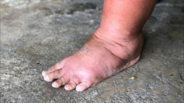 Say Goodbye to Swelling with Vitamin B6 – Green Tricks