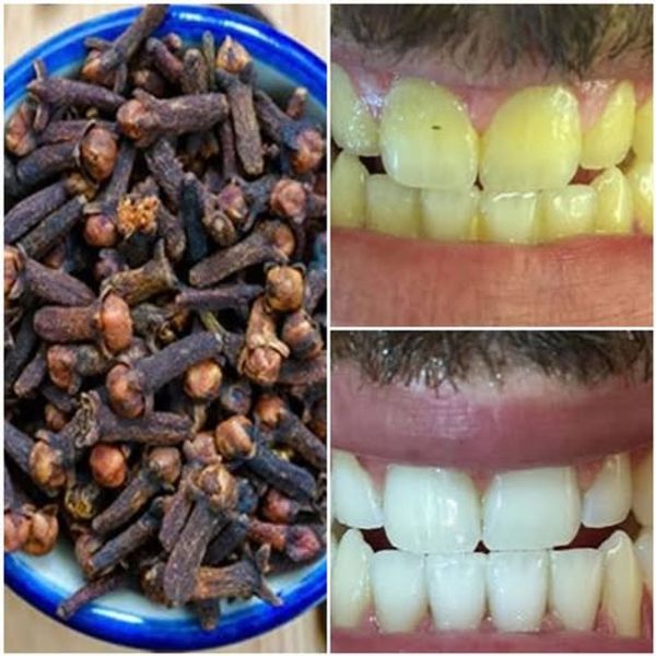Whiten Teeth & Remove Tartar in 1 Minute with Cloves! 🌟 – Green Tricks