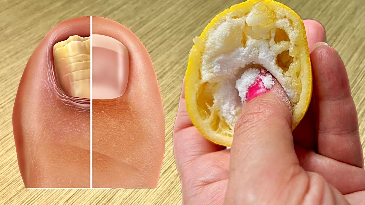 Nail Fungus Removal: 100% Natural Treatment for Toenail Fungus 🍋 With ...
