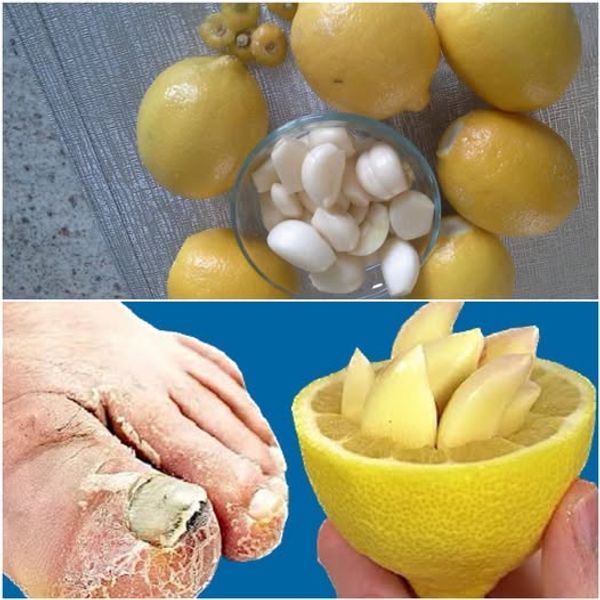 Natural Toenail Fungus Removal with Garlic and Lemon – Green Tricks