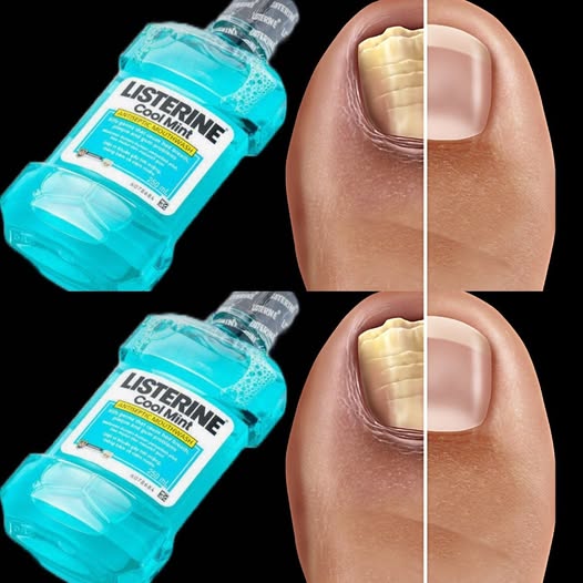 THIS EASY RECIPE Will Get Rid of Nail Fungus – Forever! (Using ...