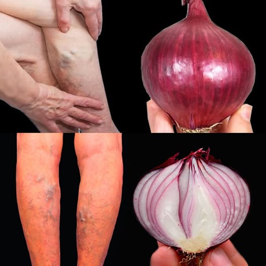 Unbelievable! 🤩 It’s a Varicose Vein Killer! Red Onion’s Top 5 Home ...