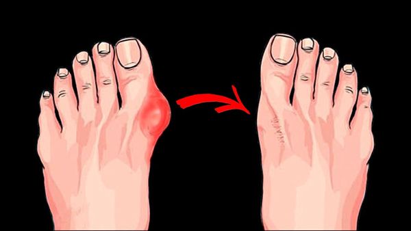 Natural Methods to Ease Foot Bumps and Bone Protrusions – Green Tricks